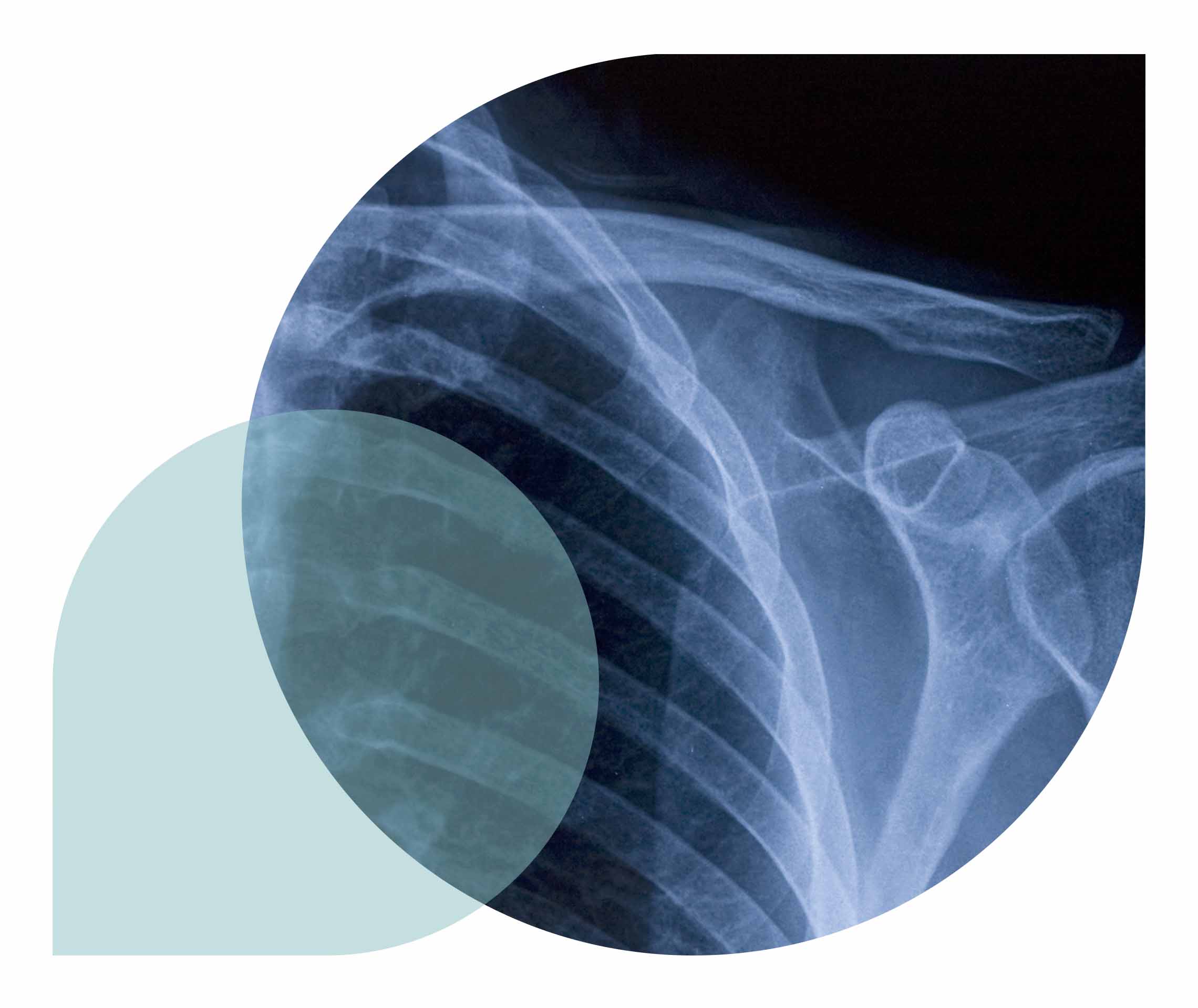 Polymyalgia rheumatica: Symptome und Ursachen | ratgeber-rheuma.de